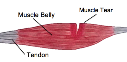 The Four Biggest Mistakes You Can Make After A Muscle Tear - Cumberland ...